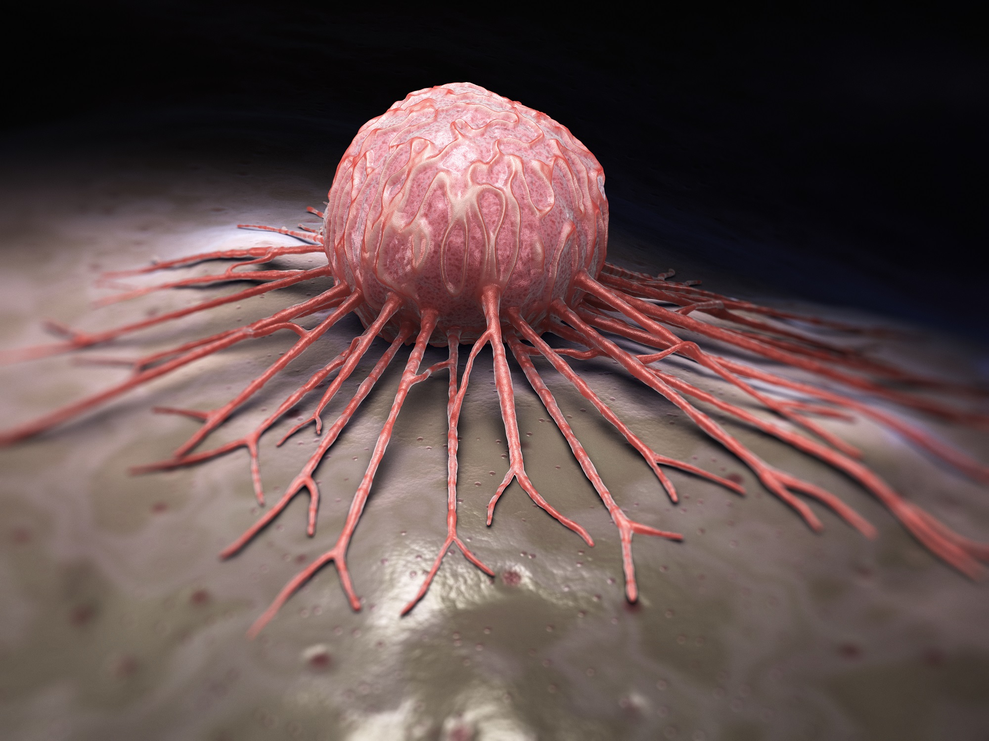 Breast Cancer And Neuroendocrine Tumors Co Occurrence More Than
